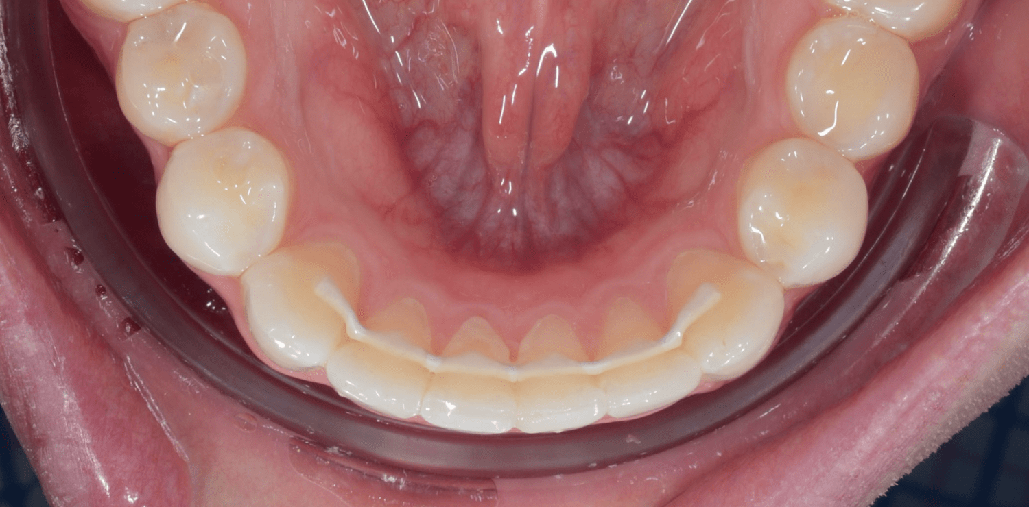 Orthodontic Retainer Wire - The Complete Guide | eZtain Lab