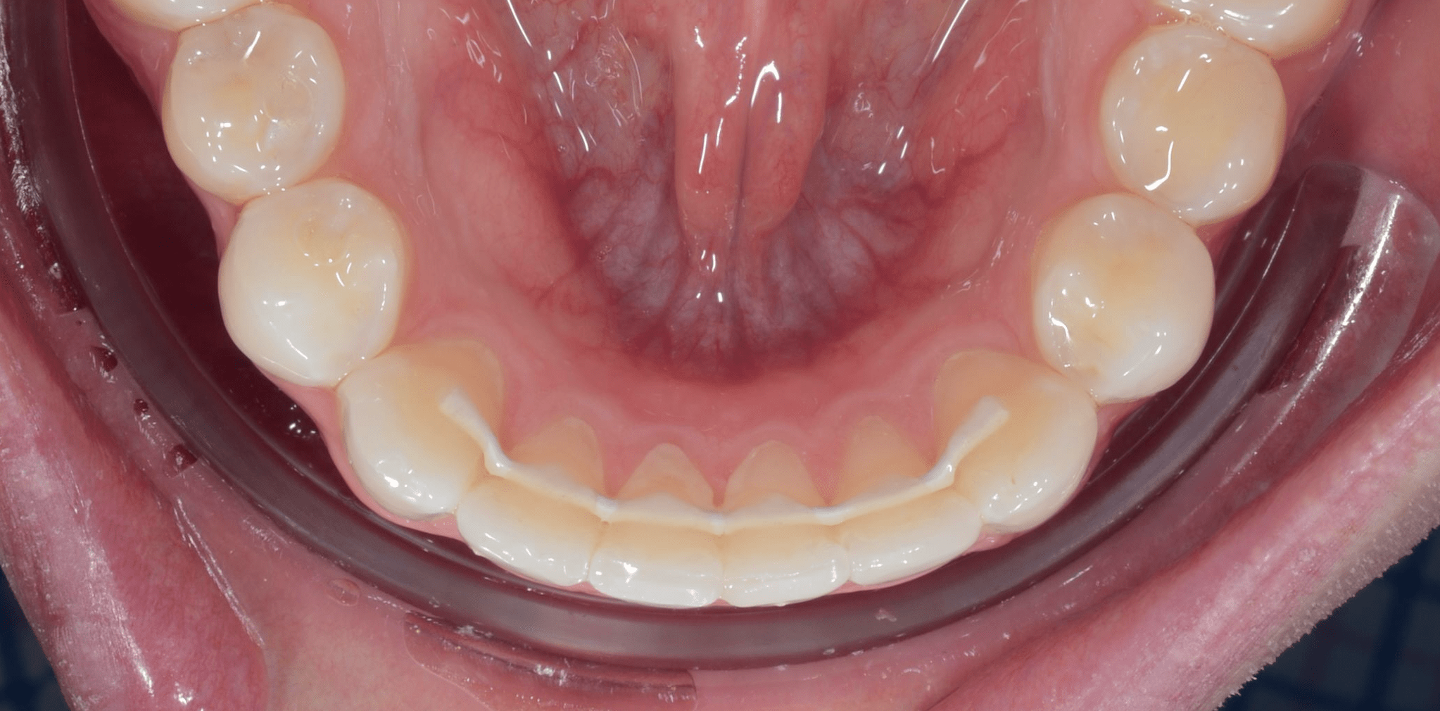 Orthodontic Retainer Wire - The Complete Guide | eZtain Lab