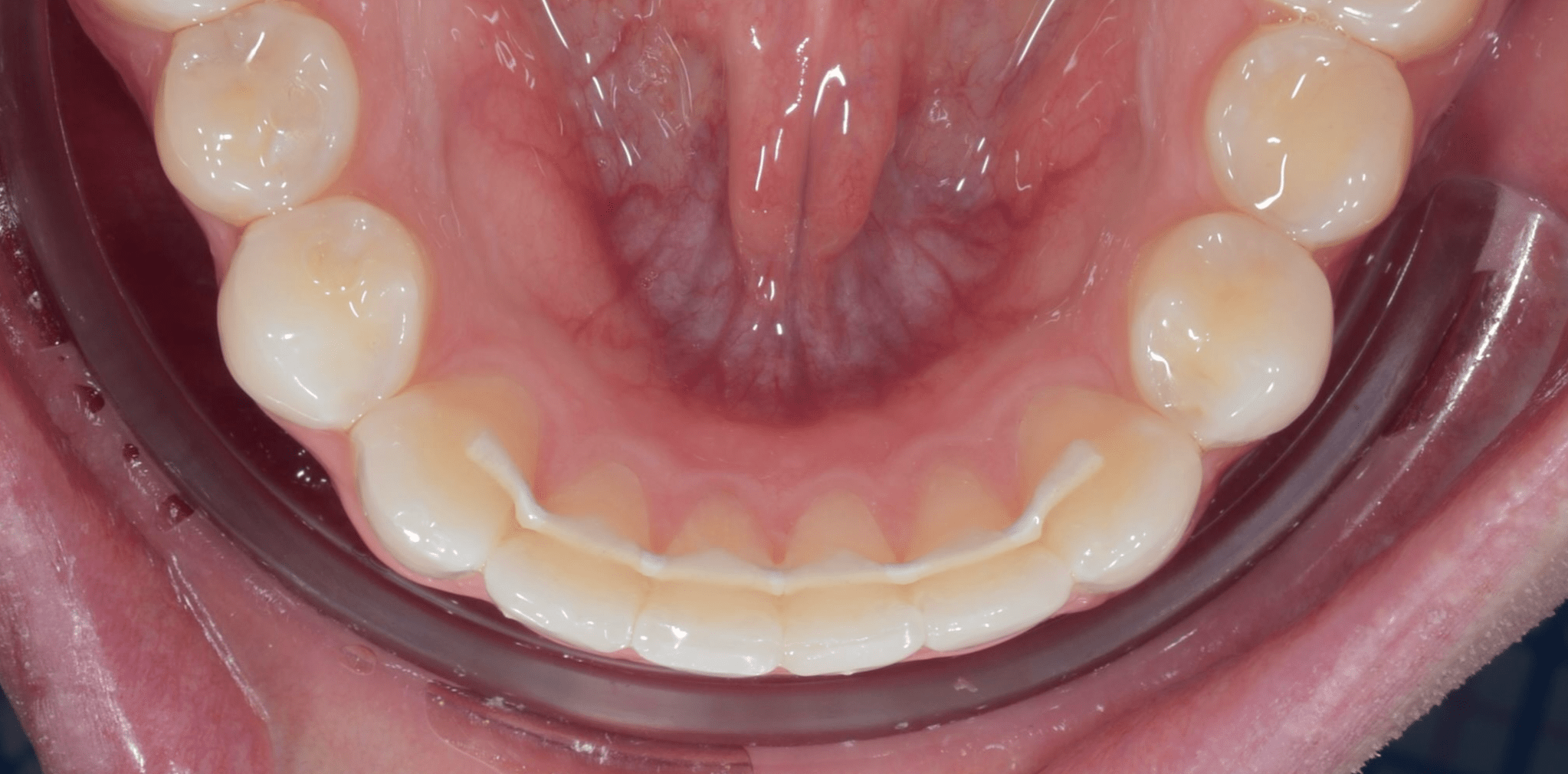 eZtain | Custom-made PEEK orthodontic fixed retainer