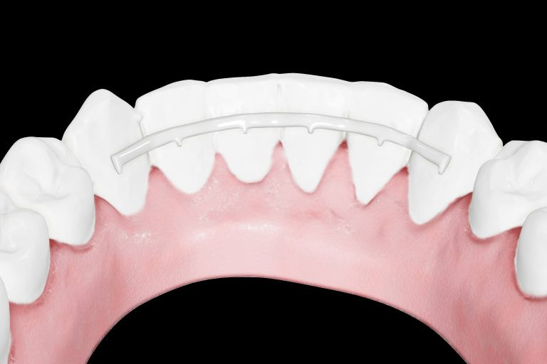 Pose d’un fil de contention dentaire : procédure et conseils | eZtain Lab